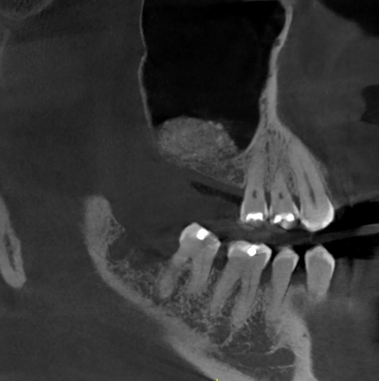 Sinus Lifts - DentalMed Associates